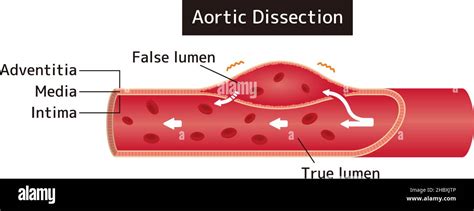 Aortic Dissection Cross Section