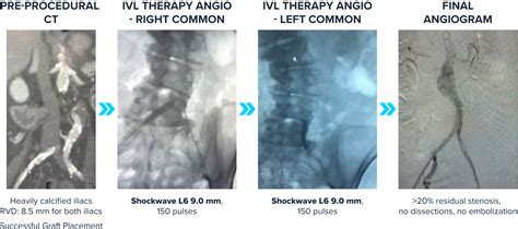 Ivl For Pre Evar Shockwave Medical