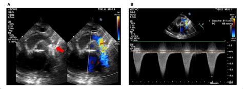Post Intervention Echocardiography A Stent Visualization In The
