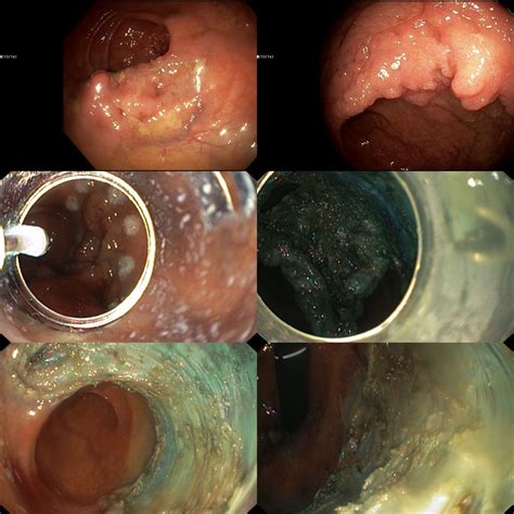 Davide Stradella On Linkedin Endoscopy Safeendoscopy Esd