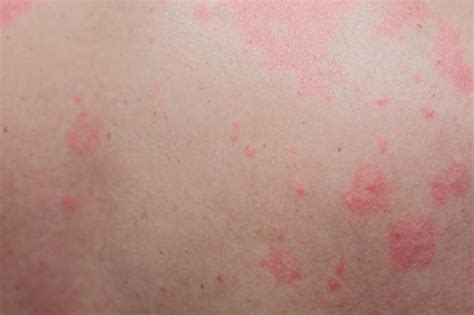 Premium Photo Close Up Allergy Rash Around Back View Of Human With