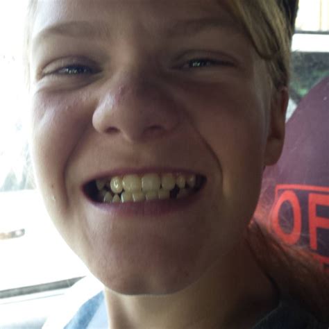 Last One To Finally Get Her Braces Off Now For A Year Or So Of Wearing