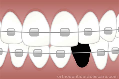 Taking Braces Off At Home Should You Do How Orthodontic Braces Care