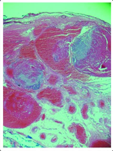 Numerous Dilated Vascular Spaces Lined By Endothelial Cells Download Scientific Diagram