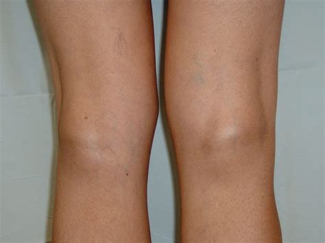 Bakers Popliteal Cyst Posterior View Rheumexam Atlas