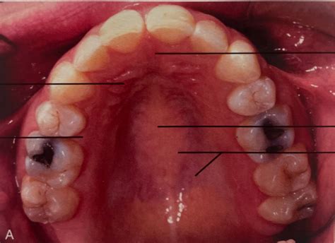 Hard Palate Diagram Quizlet