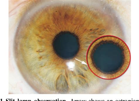 Figure 1 From Angiography Reveals Early Hiding Iris Neovascularization