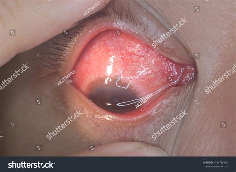 Conjunctivitis Más De 15 644 Fotos De Stock Con Licencia Libres De