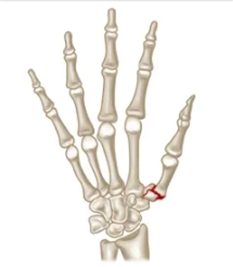 Comprehensive Guide To Understanding Rolando S Fracture