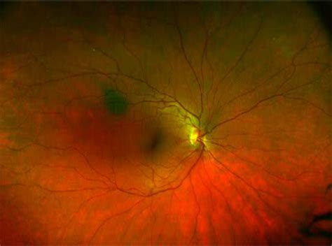 Congenital Hypertrophy Of The Rpe Page 30 Of 44 Retina Revealed