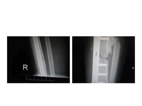 Plating Tibia Taif Ppt