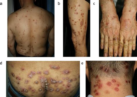 Histological Observations Of Lesional Skin Biopsy From Prurigo