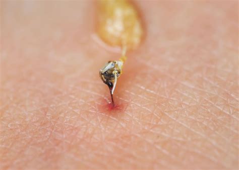 23 Best Bee Sting Home Remedies The Happy Chicken Coop