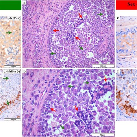 Morphological And Immunohistochemical Features Of The Gonadoblastoma