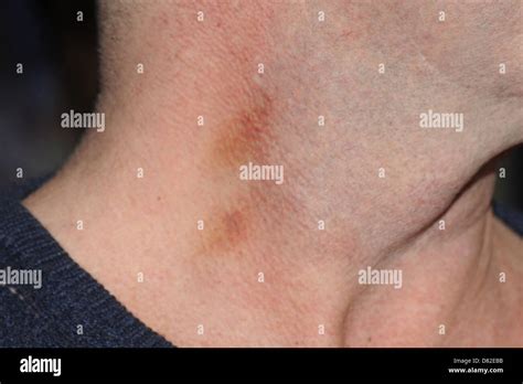 Love Bite Marks On Neck