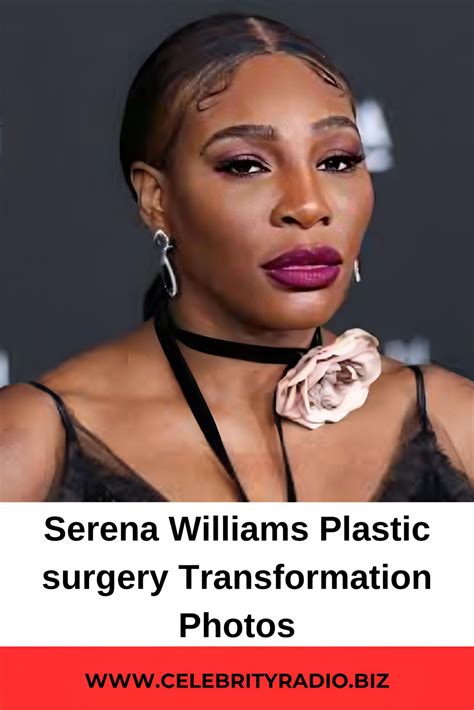Serena Williams Plastic Surgery Transformation Photos Serena Williams