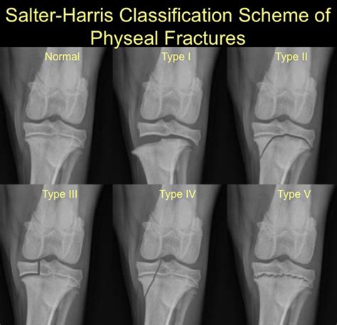 Epiphyseal Fracture X Ray