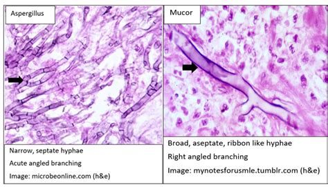 Mucormycosis Hyphae