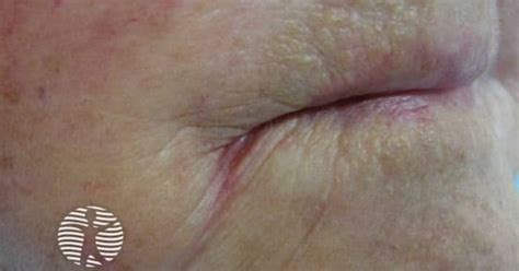 Angular Cheilitis Image