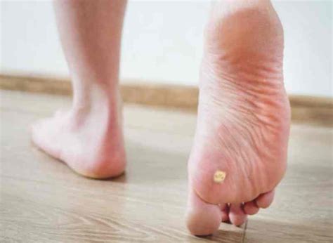 Comment reconnaître une verrue plantaire Les Allobroges