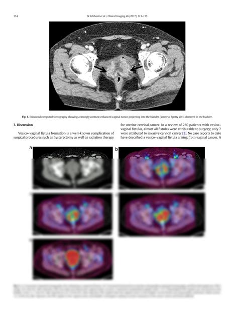 Solution Vaginal Tumor Vesical Fistula Detected By Dynamic