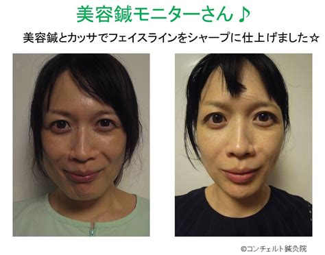 美容鍼メニュー ｜練馬区平和台のコンチェルト鍼灸院
