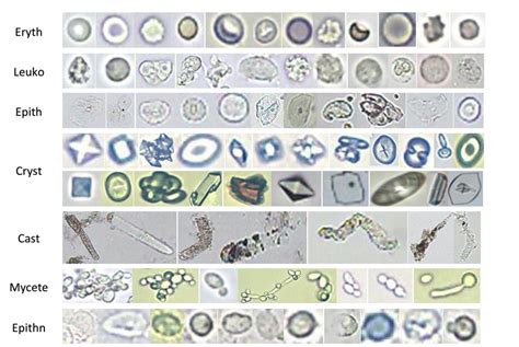 Cnn Based Automatic Urinary Particles Recognition Deepai