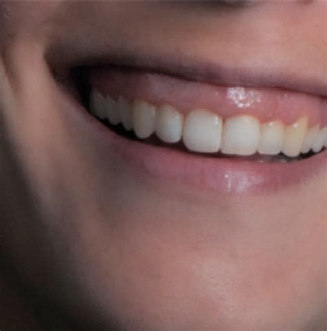 Sonrisa Gingival Causas Y Soluciones Alginet Mas Dental