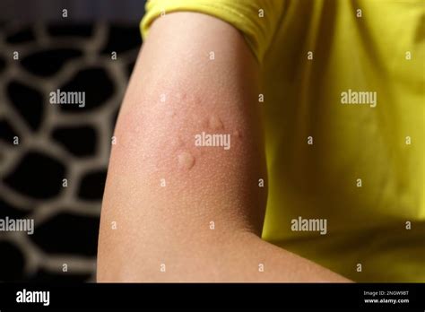 Allergy Symptoms After Injection Edematous Part Red Puncture Site
