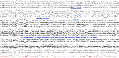 Types Of Abnormal Eeg Patterns Genspark