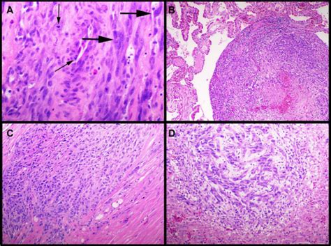 Metastatic Anaplastic Sarcoma In A Wild Lace Monitor Varanus Varius