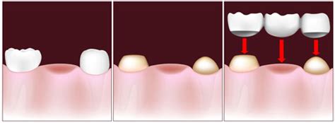 Dental Bridge Treatment Procedure Tooth Bridge Cost