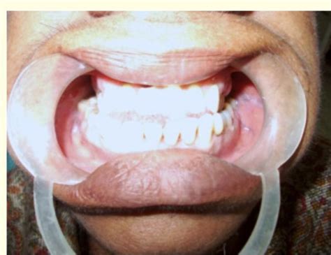Maxillary And Mandibular Arch Showing Cross Bitetelescopic