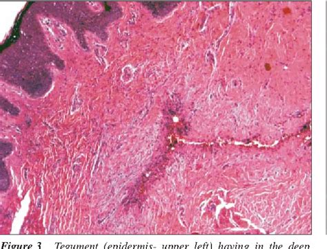 Figure 3 From Primary Umbilical Endometriosis Villars Nodule Case