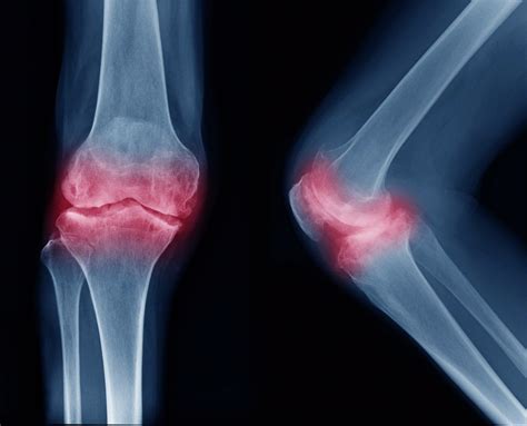 类风湿关节炎病人要做哪些检查3种检查因人而异 京东健康