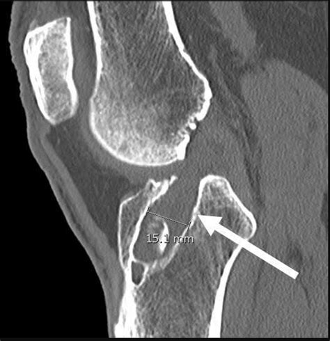 Best Acl Surgeon Acl Ligament Surgery In Jaipur Kneecares