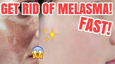 Gamot Sa Pamamaga Ng Mukha