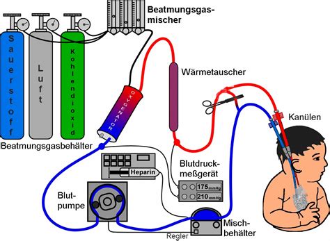 Extrakorporale Membranoxygenierung Wikipedia