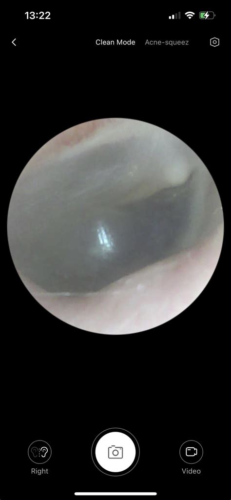 Not Earwax But Whats On My Eardrum Rearwax