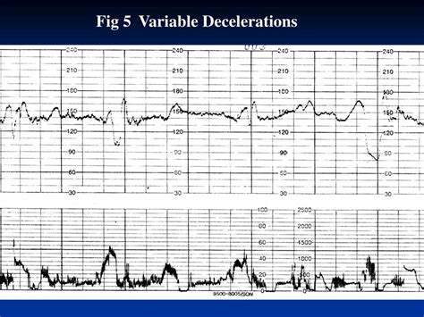 Ppt Cardiotocography Ctg Electronic Fetal Monitoring Powerpoint Presentation Id 1055126