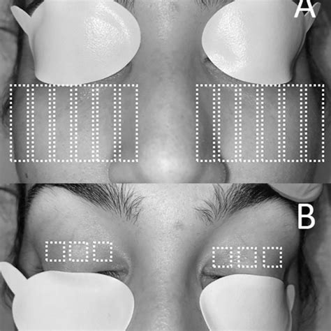 Meibography Examination Of The Upper And Lower Eyelids Before A1 A3 Download Scientific