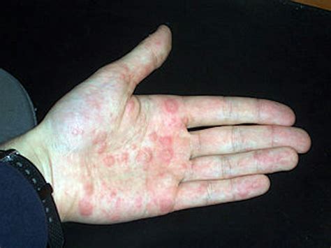 Pompholyx Causes Symptoms And Treatment Doctor