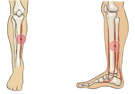 Anatomía De La Periostitis Tibial Periostitis Tibial Tratamiento Y