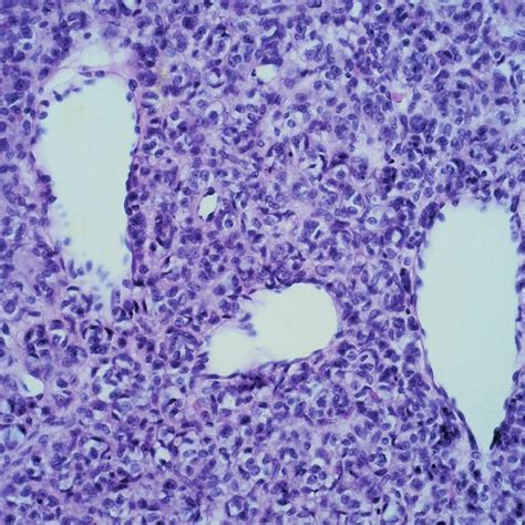 A Well Defined Solid Ovarian Mass On The Left Side Measuring 8470 Cm