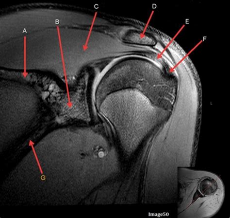 Coronal Shoulder Diagram Quizlet
