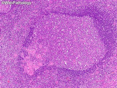 Toxoplasma Lymphadenitis