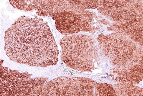 Emerging Mesenchymal Tumors Intechopen