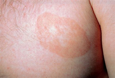 Tinea Circinata