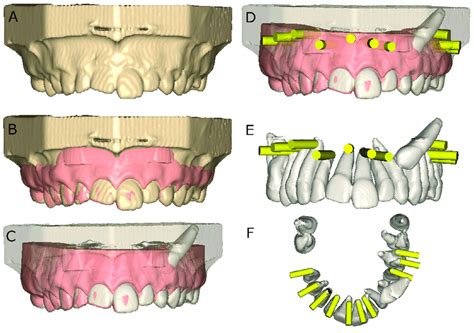 A Cbct Scan Rendering B Alignment Procedure Between Stl And Cbct