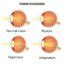 Refractive Errors Stereo Optical